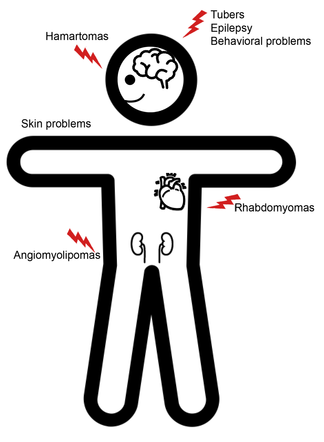 Tubereuze sclerose complex (TSC) – Encore