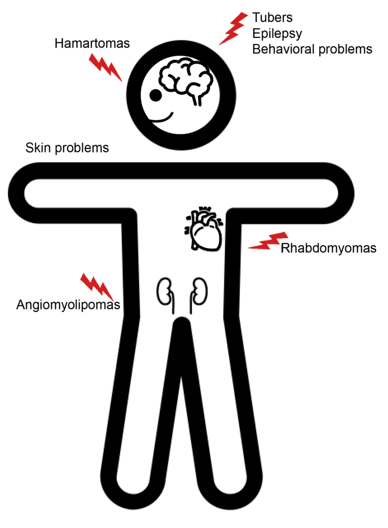 Tubereuze sclerose complex (TSC) – Encore